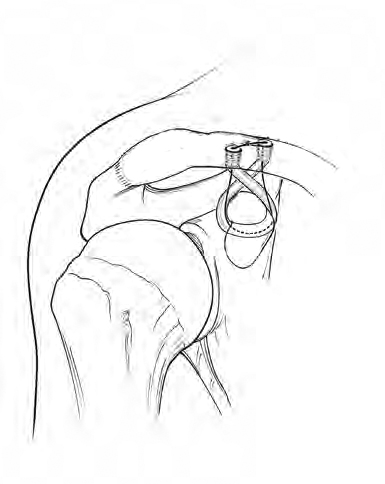 ACG-Sprengung: Schulterfacharzt Dr. med. Frauenschuh, Berlin